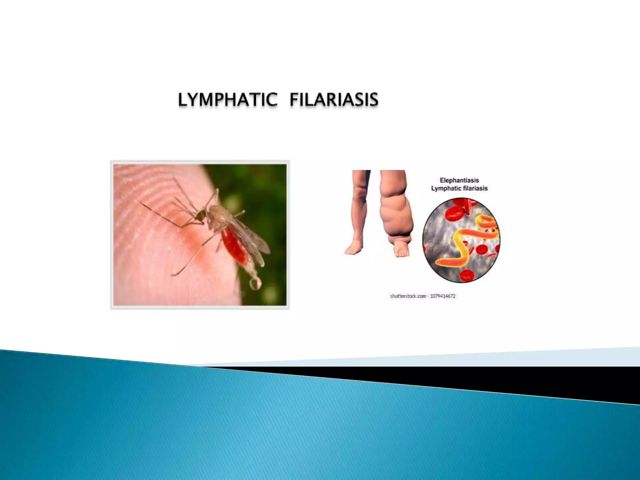 LYMPHATIC FILARIASIS .pptx