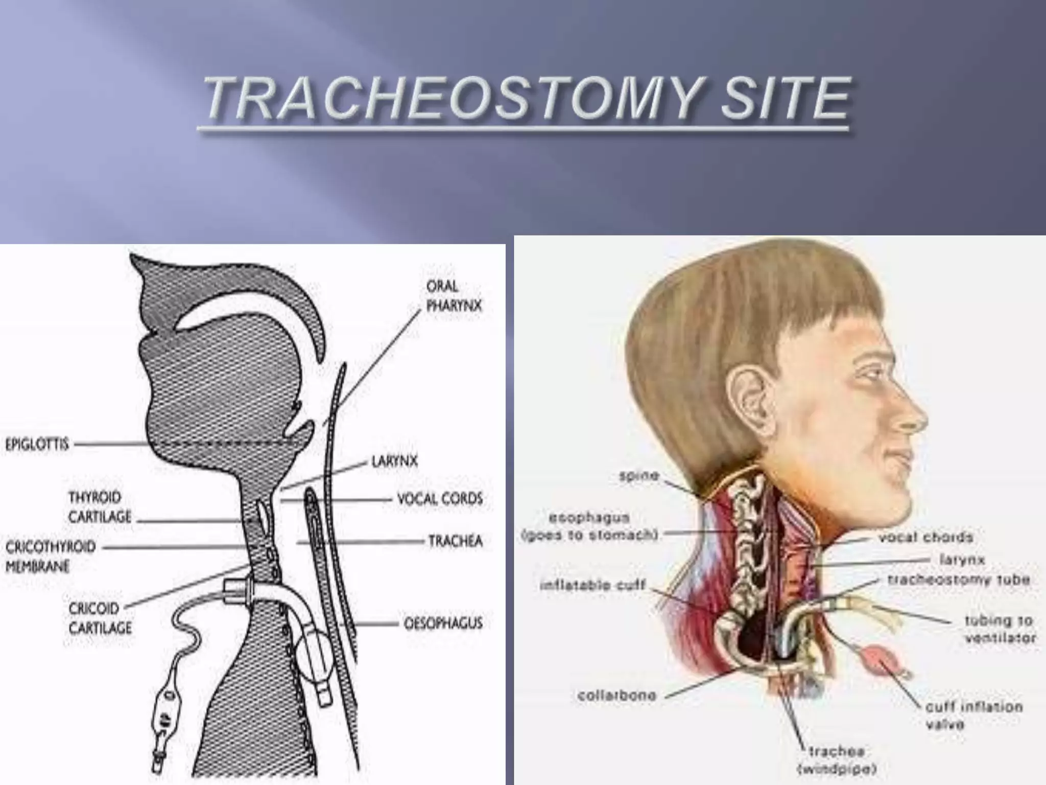 Sangeeta , clicnical anat . ppt.pptx tracheostomy | PPT