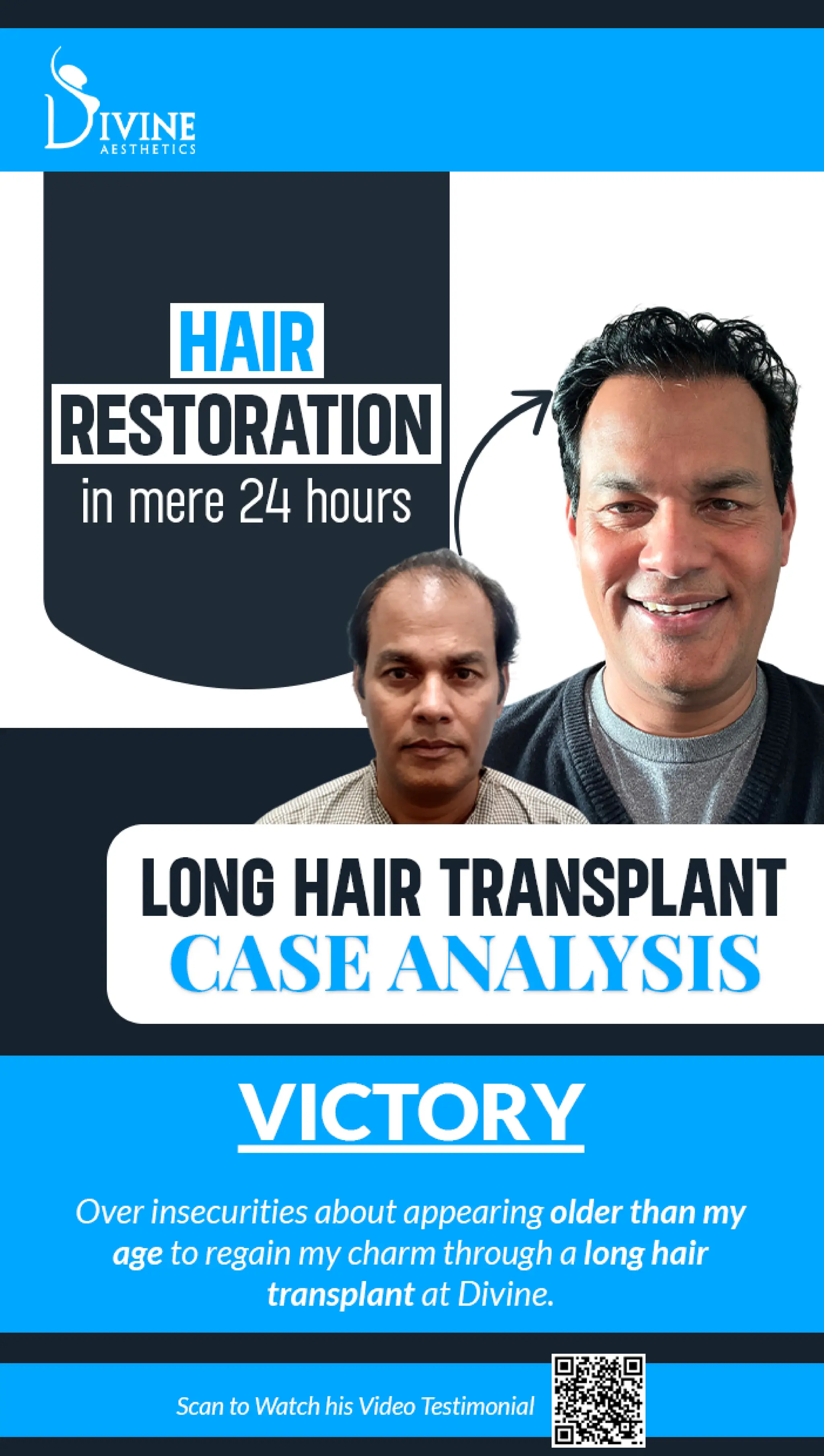 Case Study Unshaven Long Hair Transplant in India | PDF