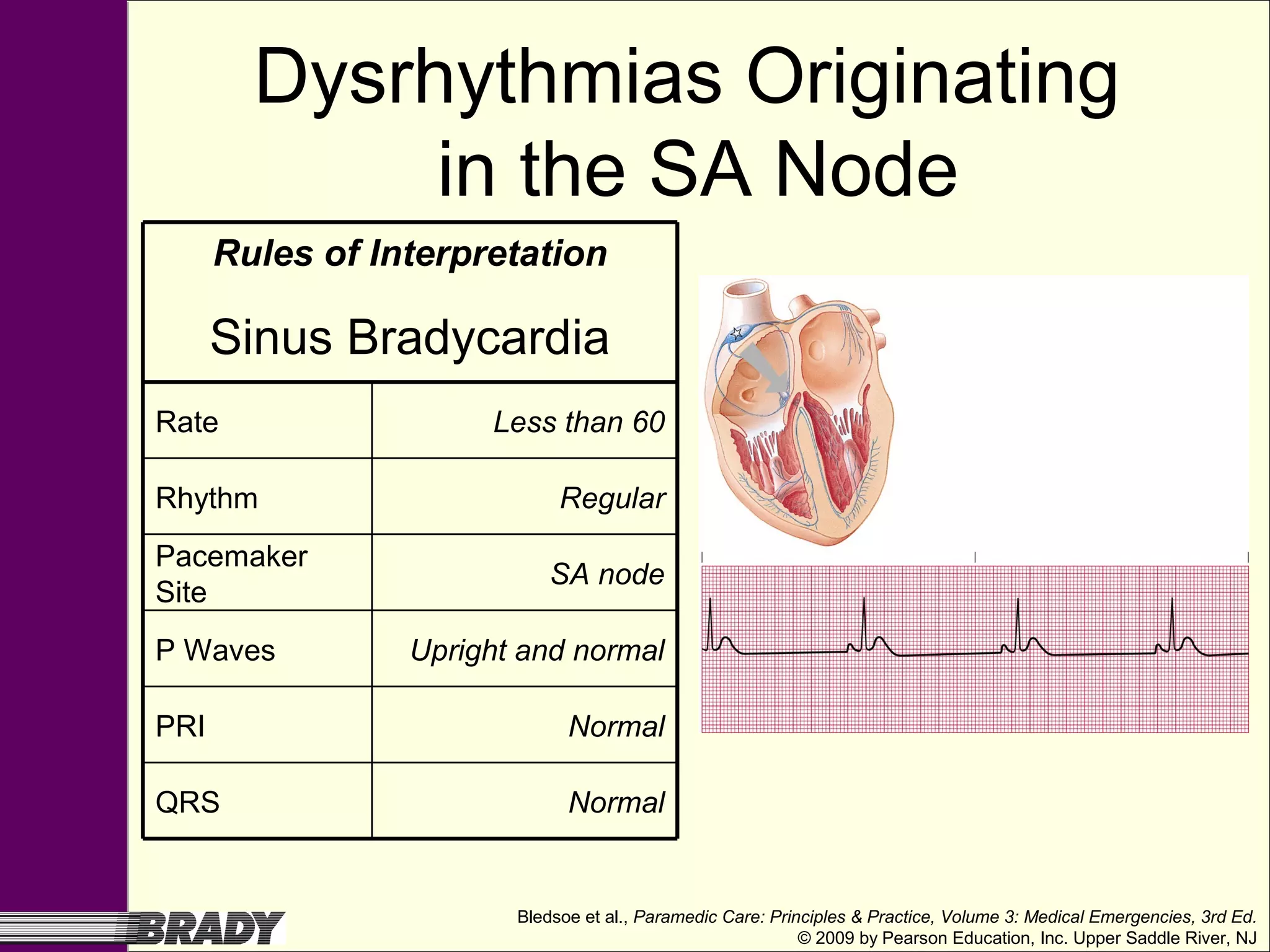 Sa node arrhythmias | PPT