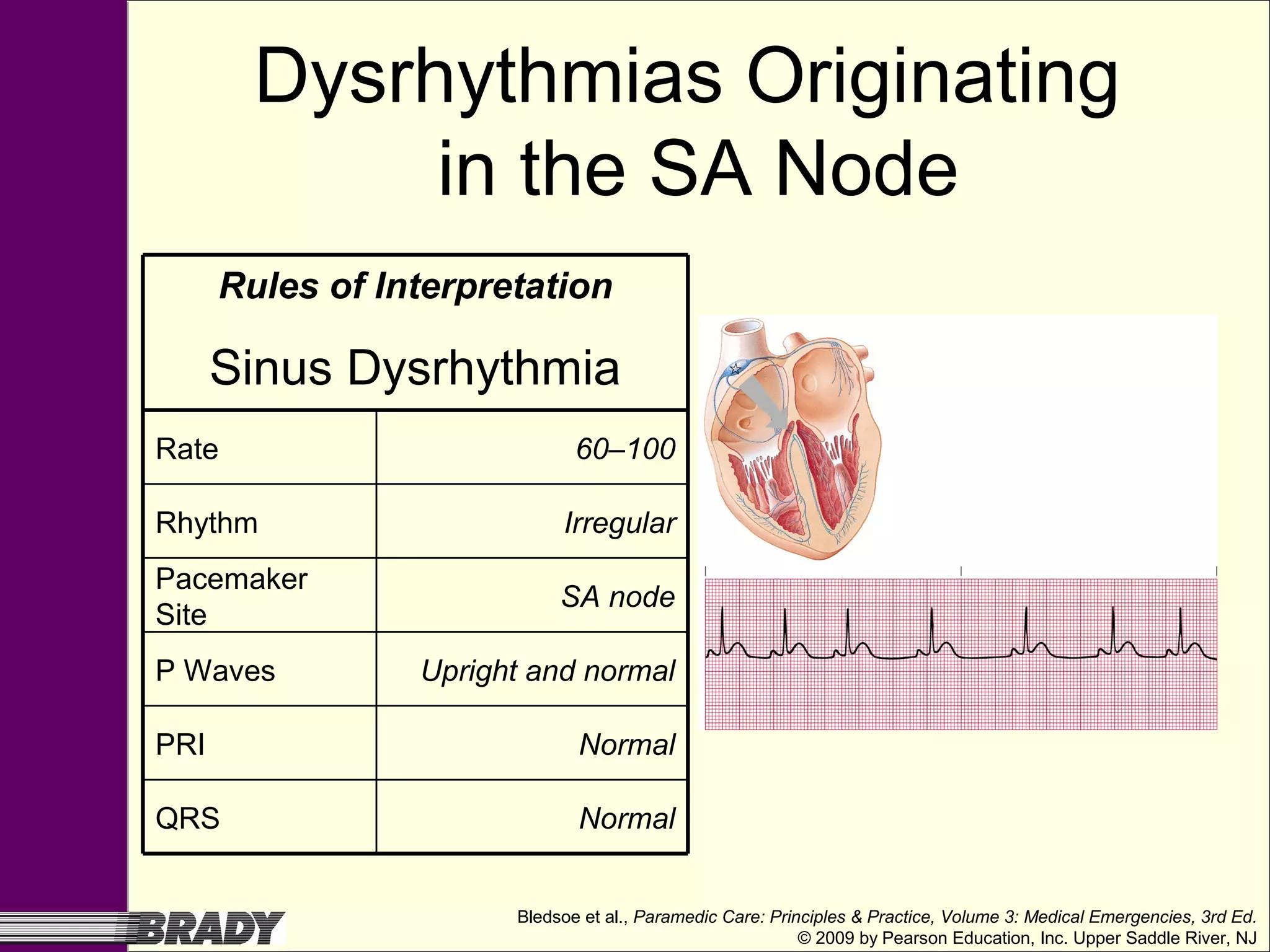 Sa node arrhythmias | PPT
