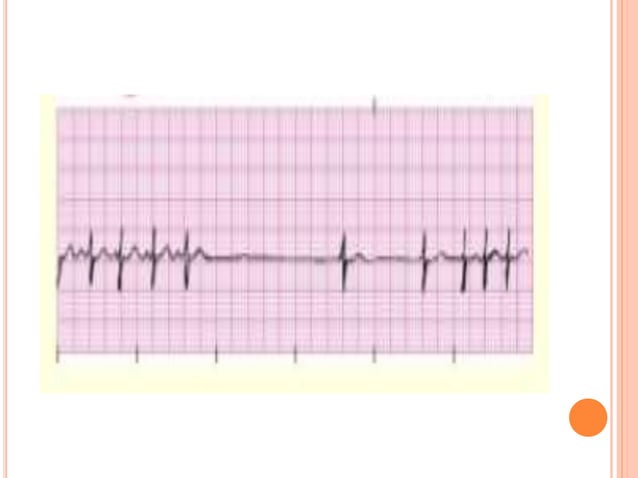 SA Node Dysrhythmia | PPTX