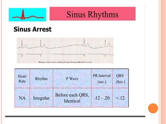 SA Node Dysrhythmia | PPTX
