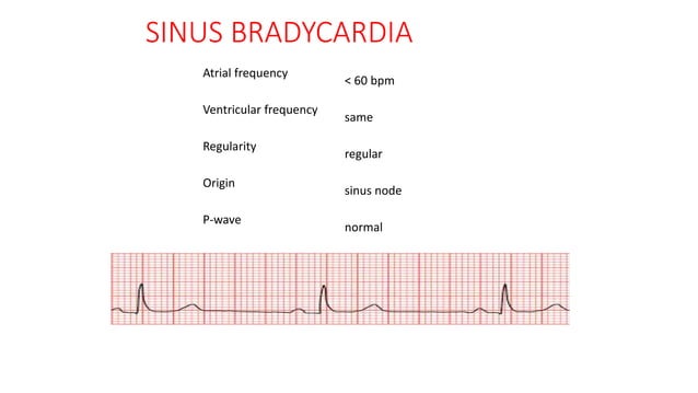 SINOATRIAL (SA) node | PPTX