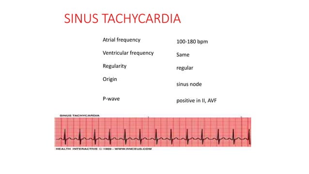 SINOATRIAL (SA) node | PPTX