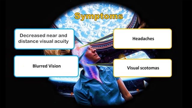 Space Flight Associated Neuro Ocular Syndrome | PDF