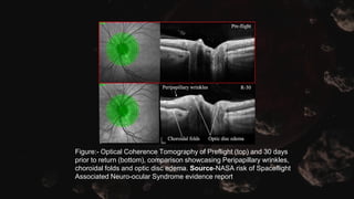 Space Flight Associated Neuro Ocular Syndrome | PDF