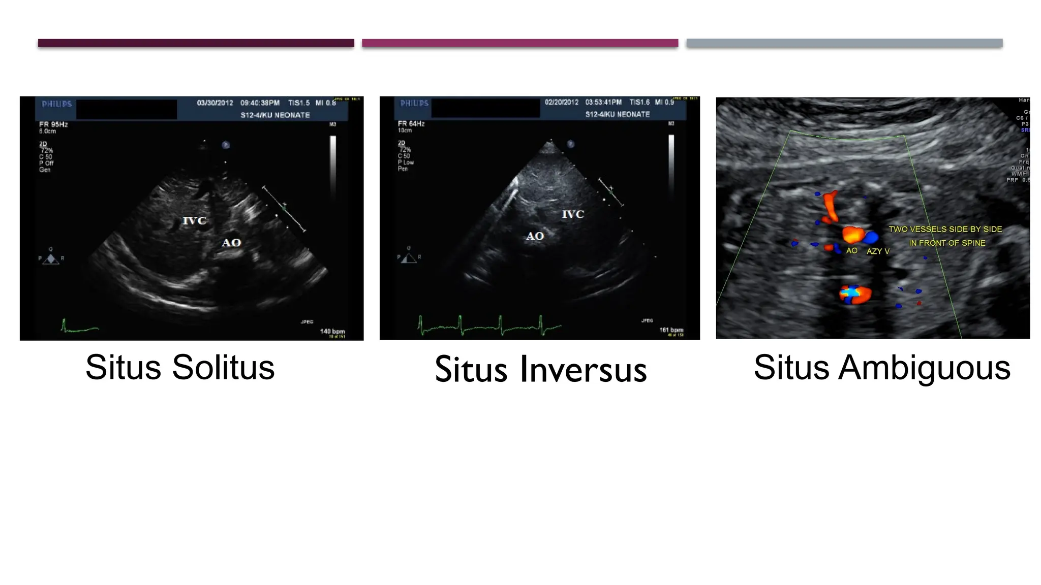 SEGMENTAL ANALYSIS of cardiac defects ppt | PPTX