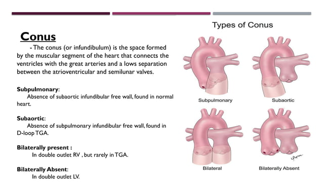 SEGMENTAL ANALYSIS of cardiac defects ppt | PPTX | Heart and ...