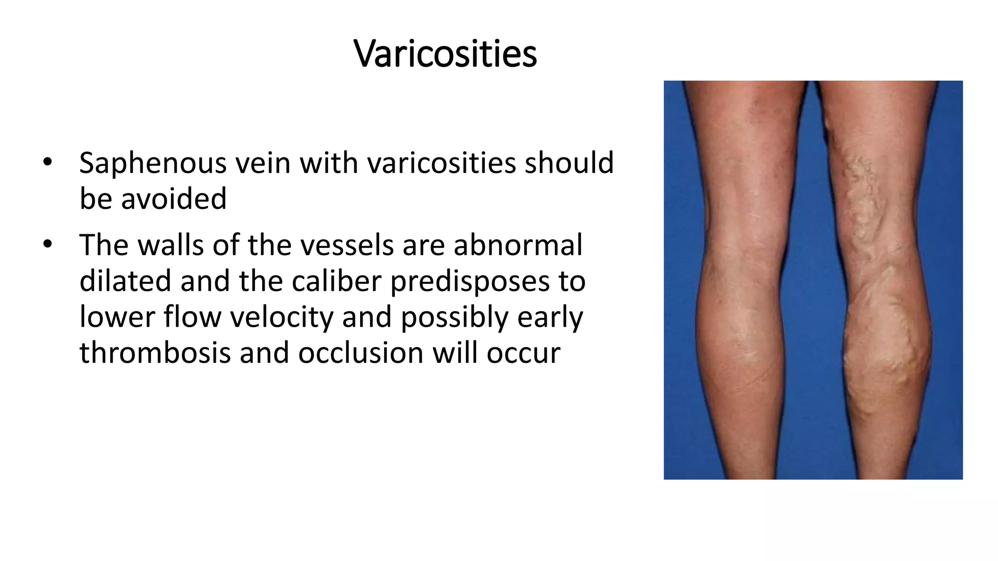 Saphenous Vein Harvesting | PPTX