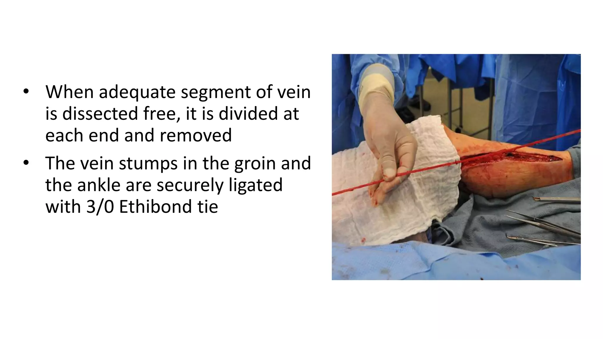 Saphenous Vein Harvesting | PPTX