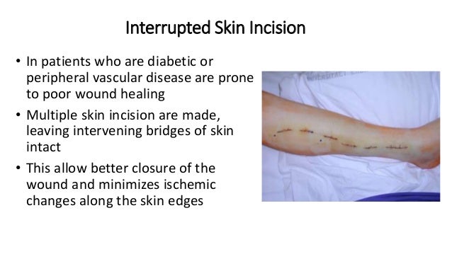 Saphenous Vein Harvesting