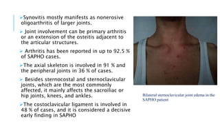 Sapho syndrome | PPTX