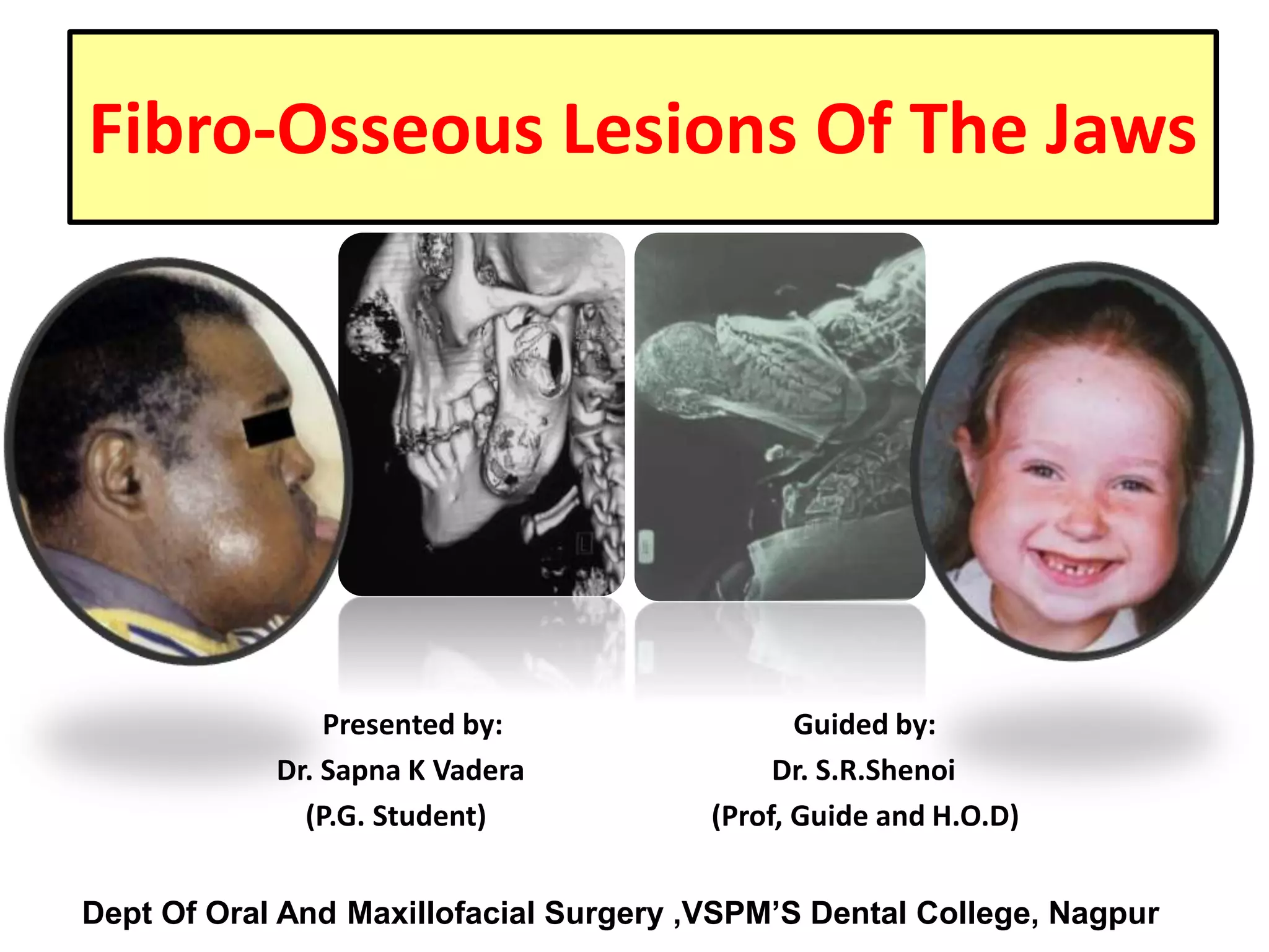 Fibro-osseous lesions of jaw | PPTX