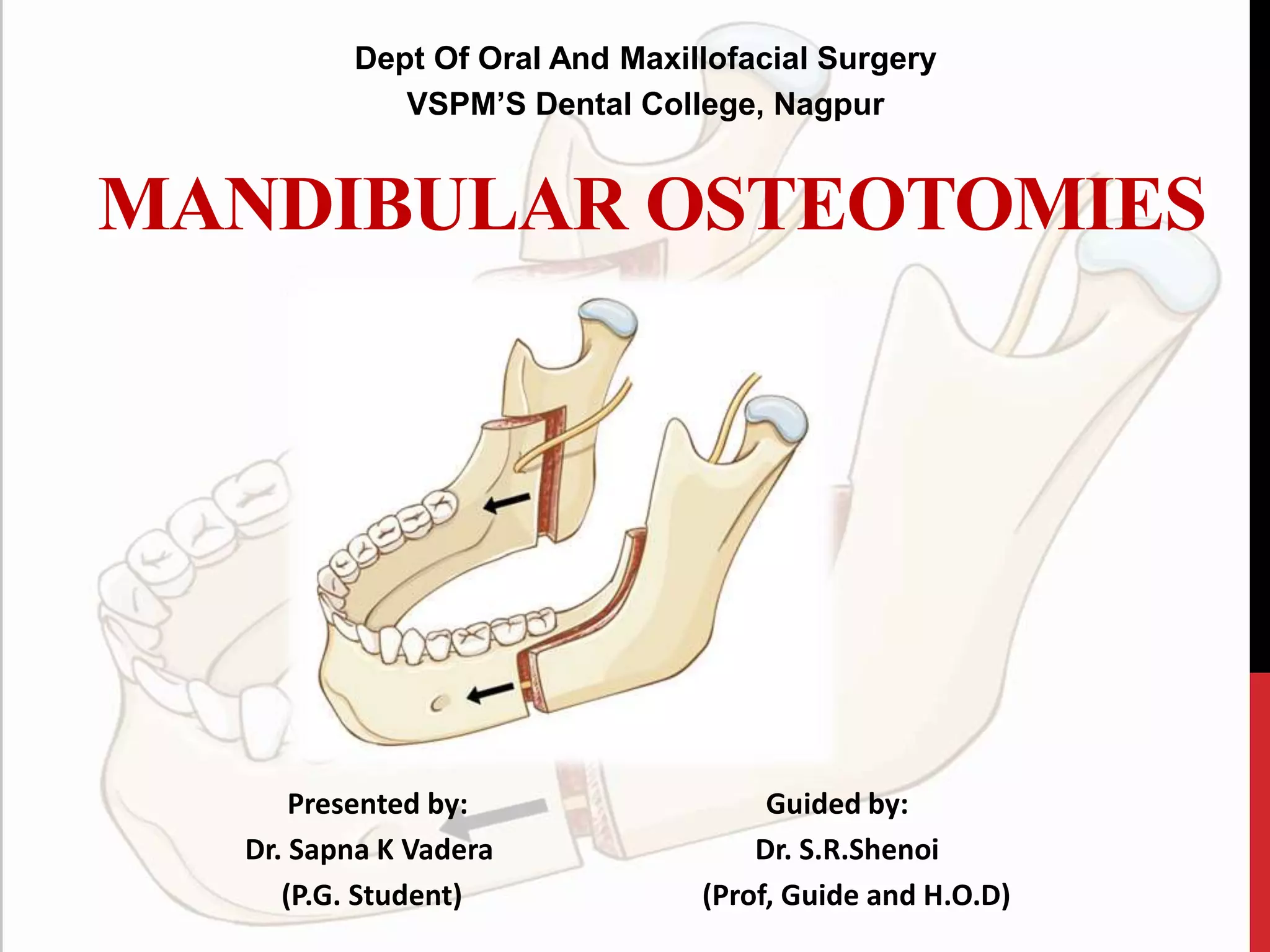 Mandibular osteotomies in orthognathic surgery of Face | PPTX