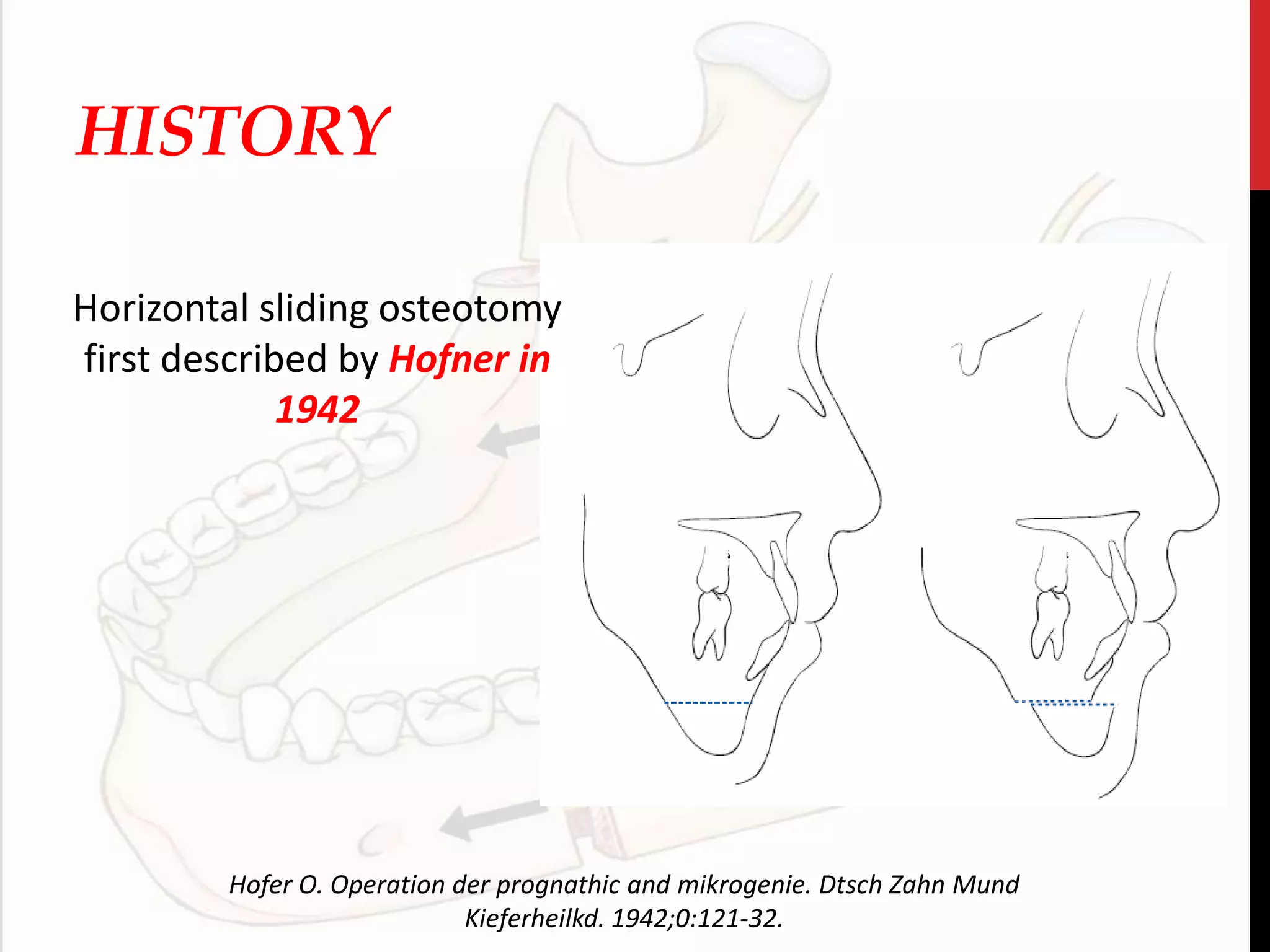 Mandibular osteotomies in orthognathic surgery of Face | PPTX
