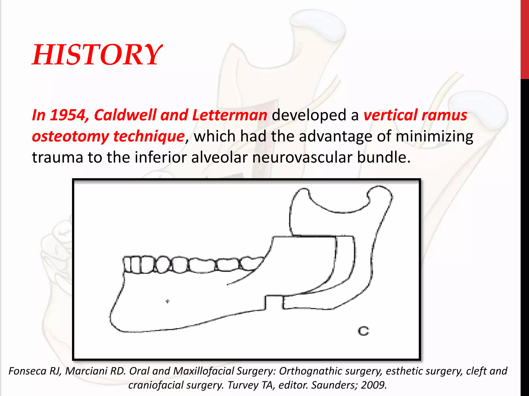 Mandibular osteotomies in orthognathic surgery of Face | PPTX