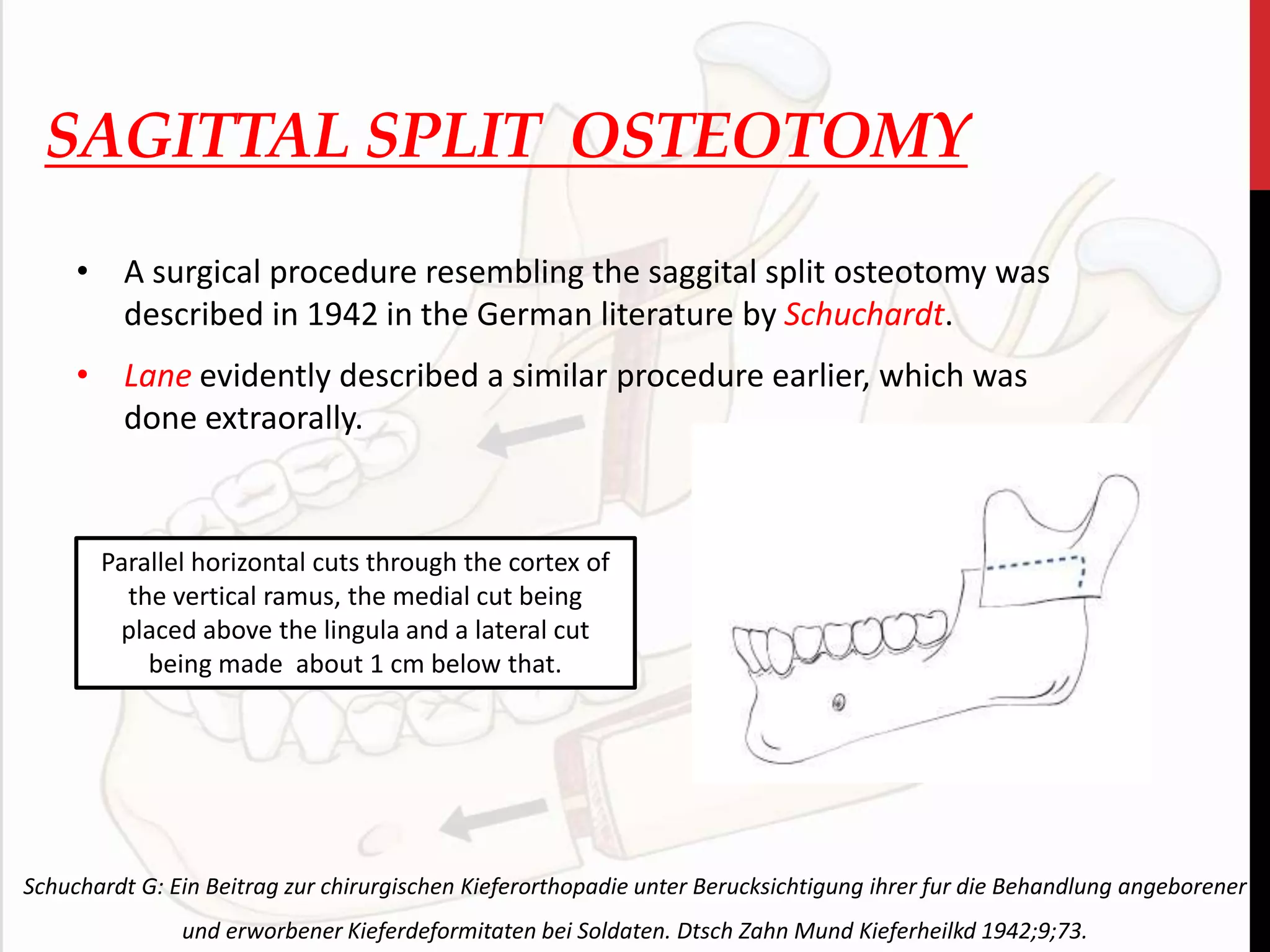 Mandibular osteotomies in orthognathic surgery of Face | PPTX