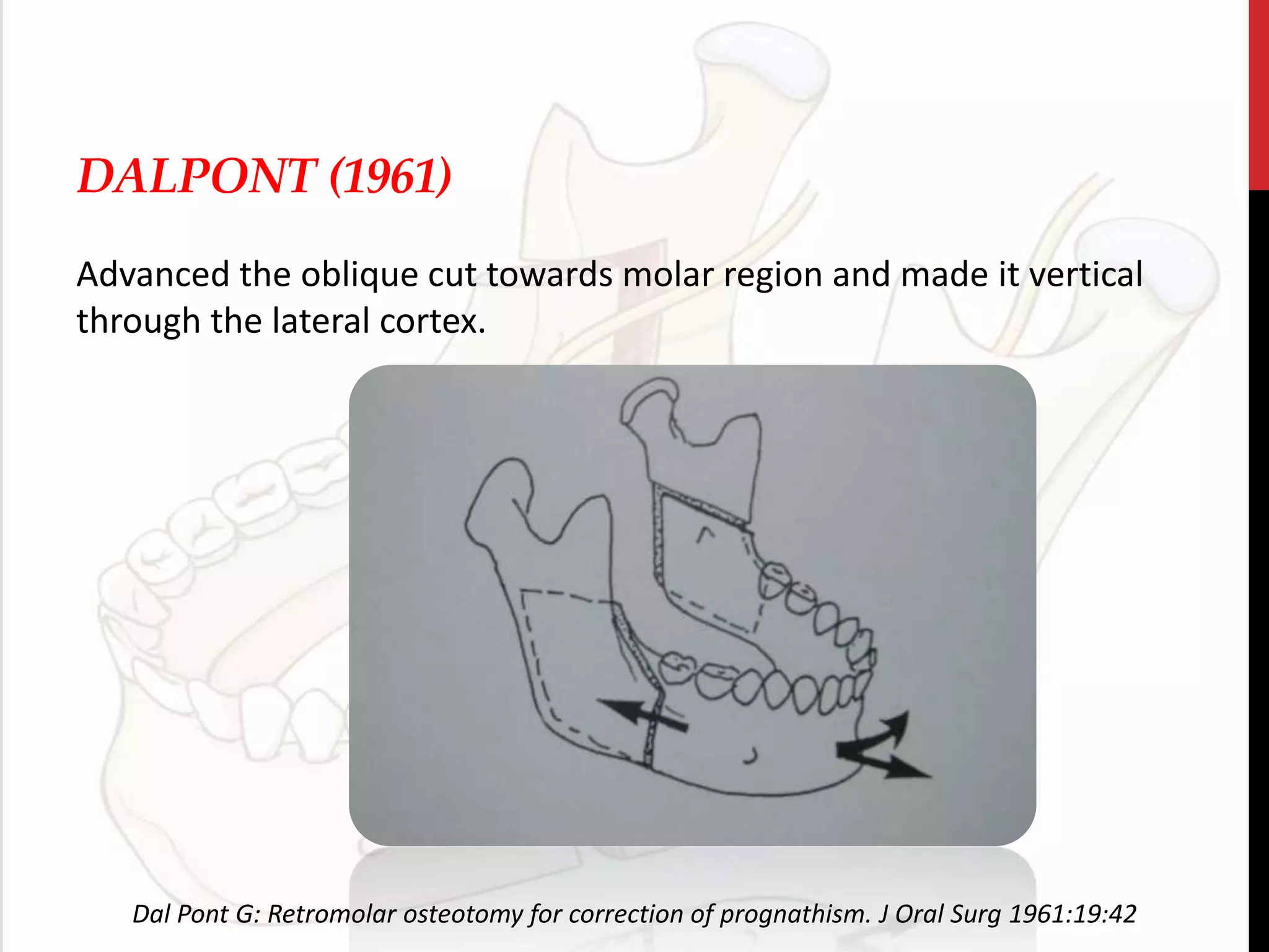 Mandibular osteotomies in orthognathic surgery of Face | PPTX