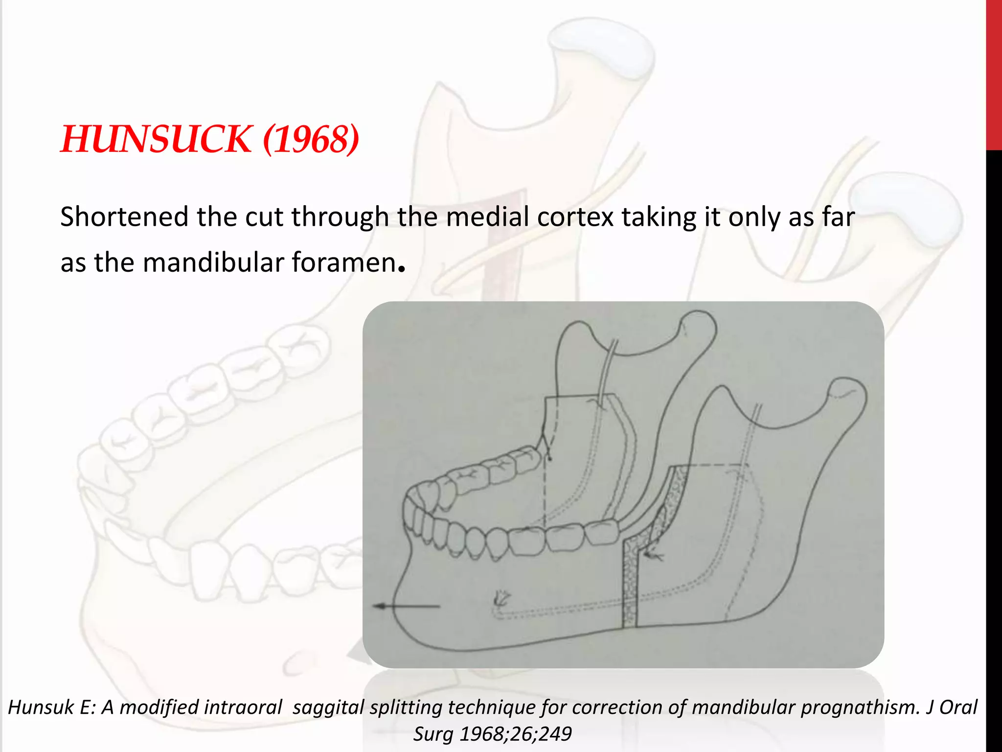 Mandibular osteotomies in orthognathic surgery of Face | PPTX