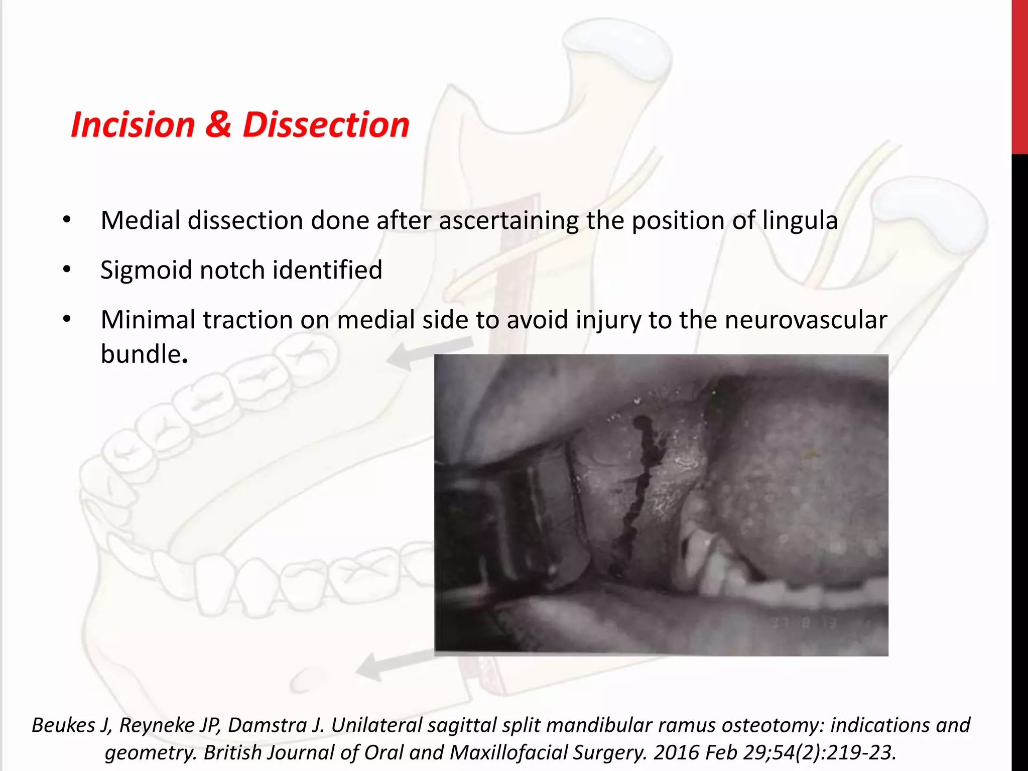 Mandibular osteotomies in orthognathic surgery of Face | PPTX