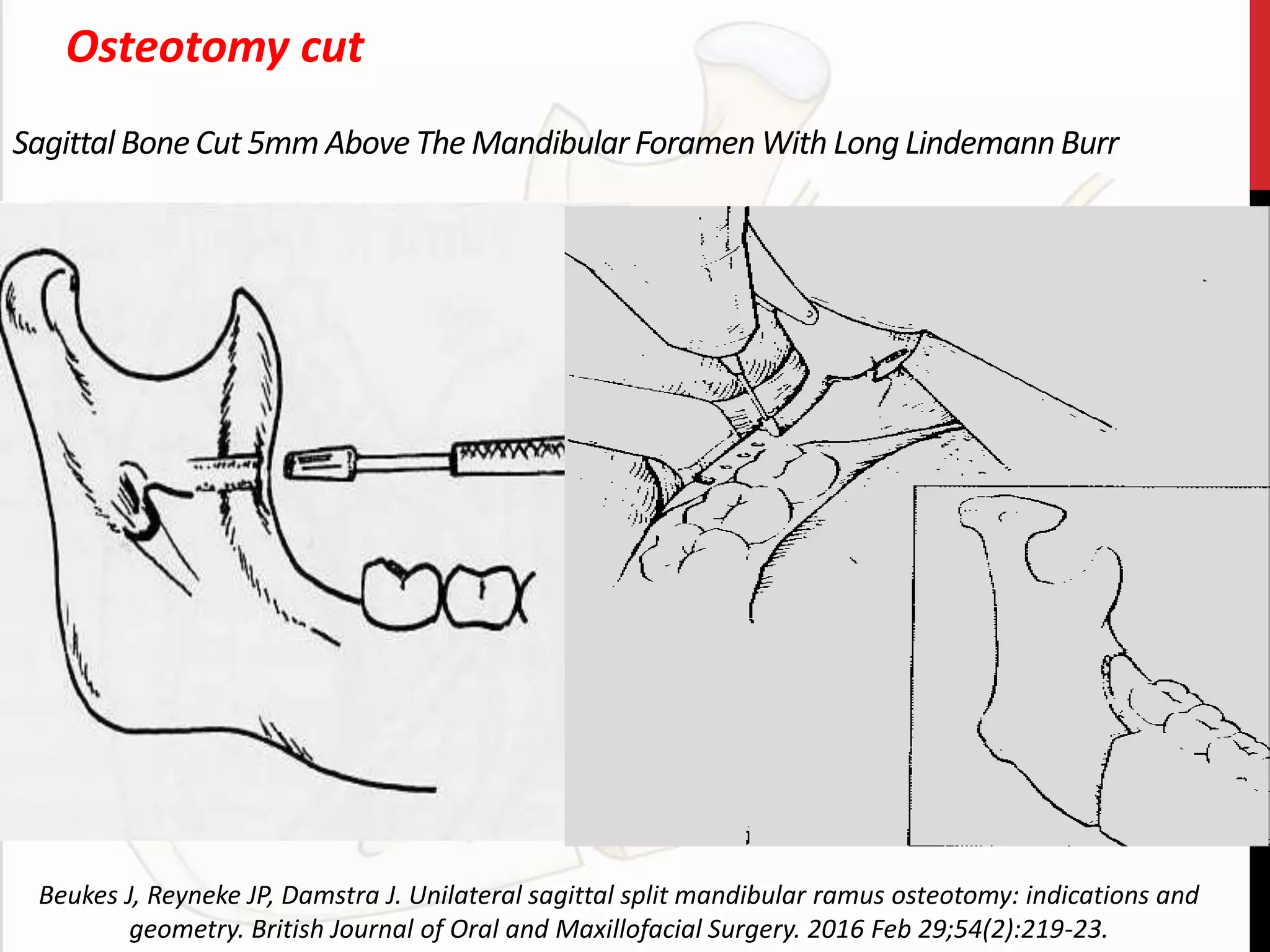 Mandibular osteotomies in orthognathic surgery of Face | PPTX