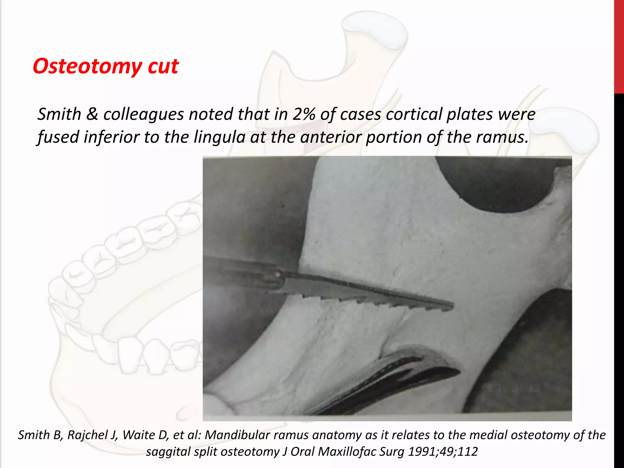 Mandibular osteotomies in orthognathic surgery of Face | PPTX