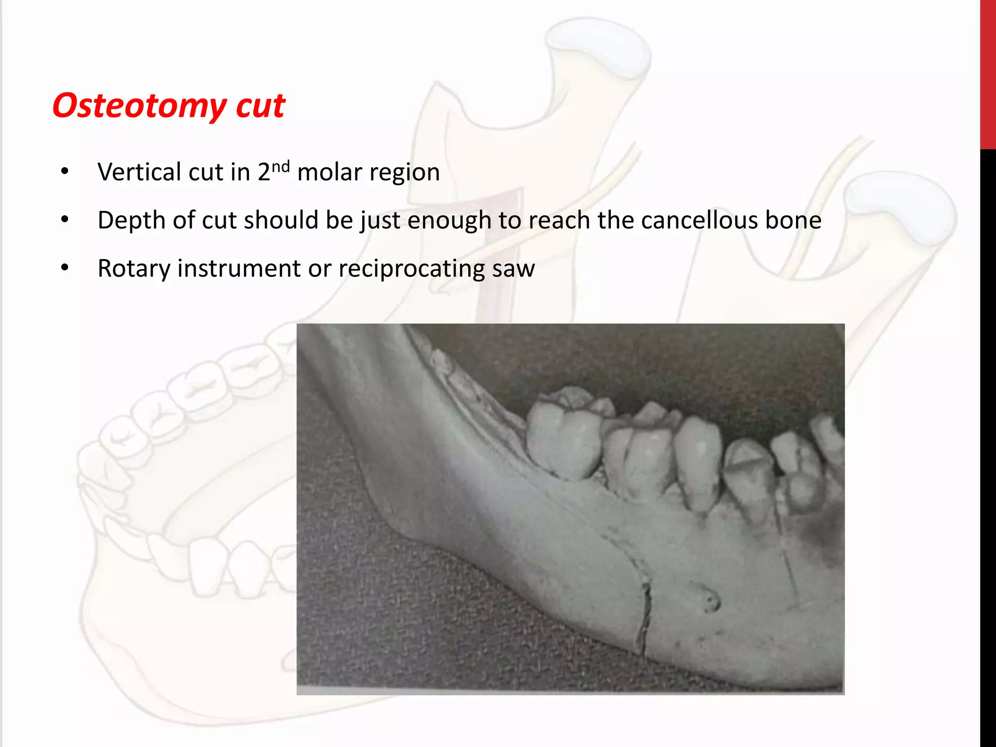 Mandibular osteotomies in orthognathic surgery of Face | PPTX
