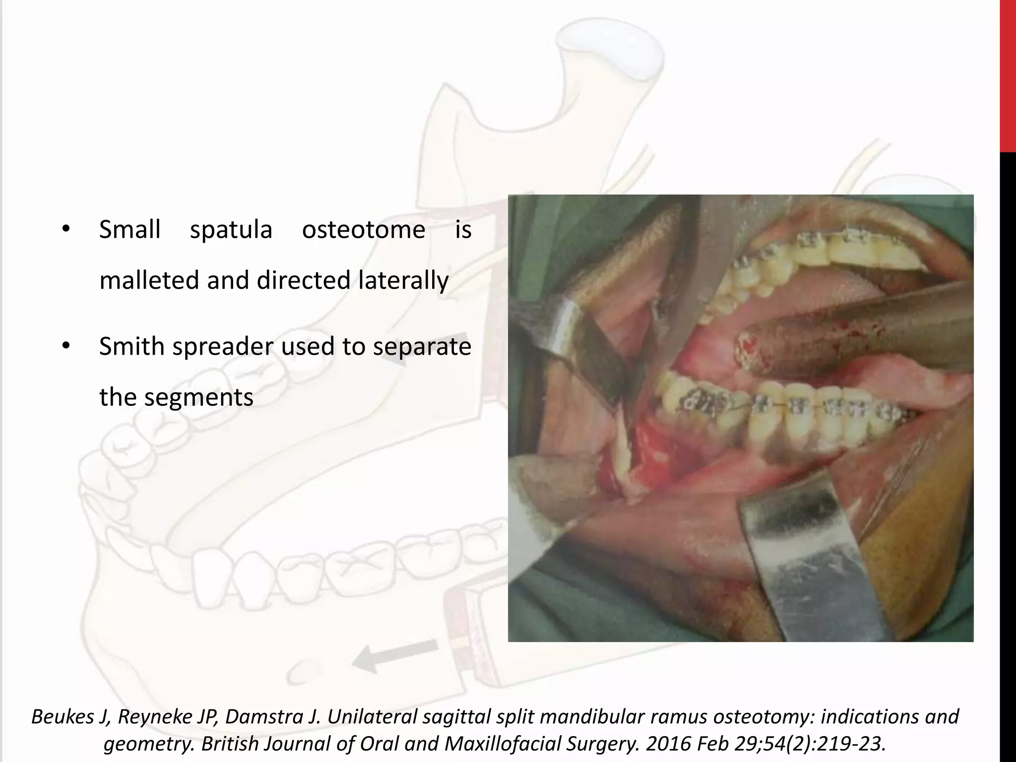 Mandibular osteotomies in orthognathic surgery of Face | PPTX