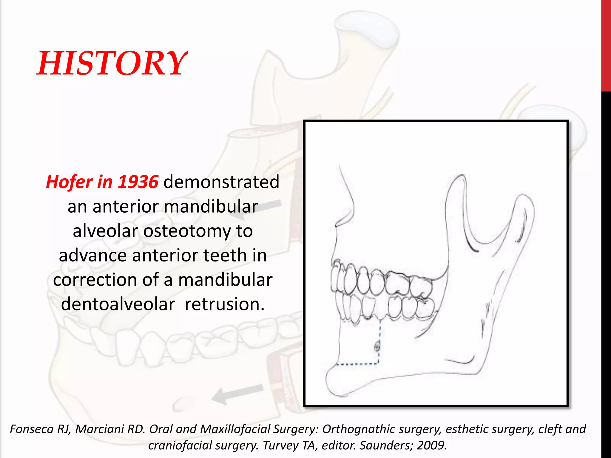 Mandibular osteotomies in orthognathic surgery of Face | PPTX