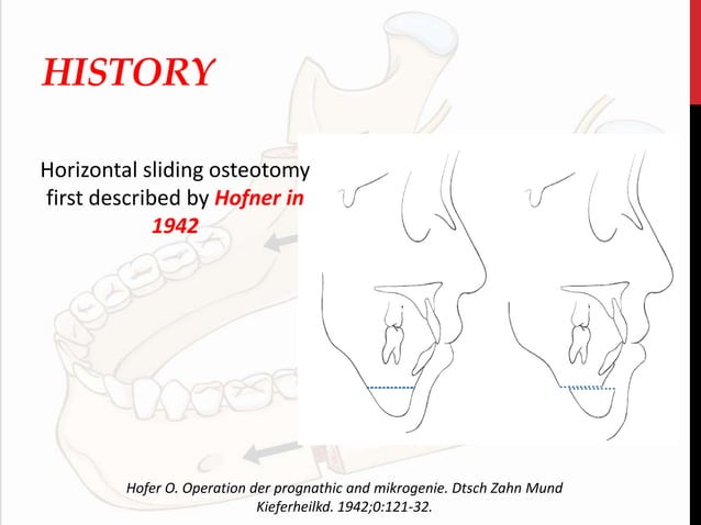 Mandibular osteotomies in orthognathic surgery of Face | PPTX