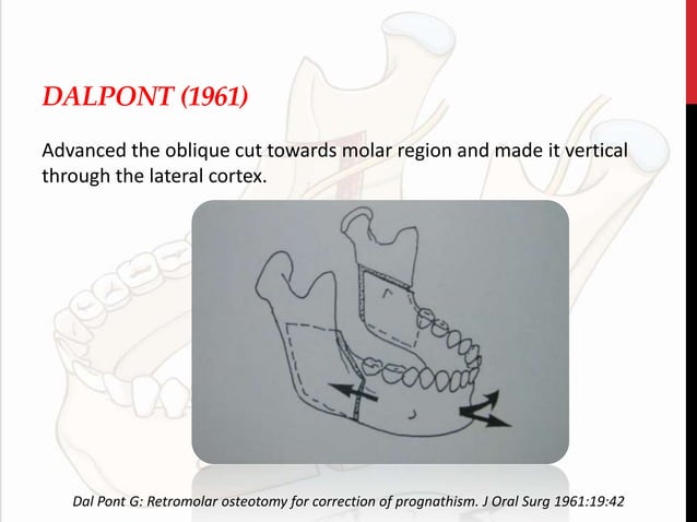Mandibular osteotomies in orthognathic surgery of Face | PPTX