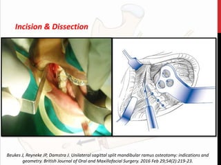 Mandibular osteotomies in orthognathic surgery of Face | PPTX