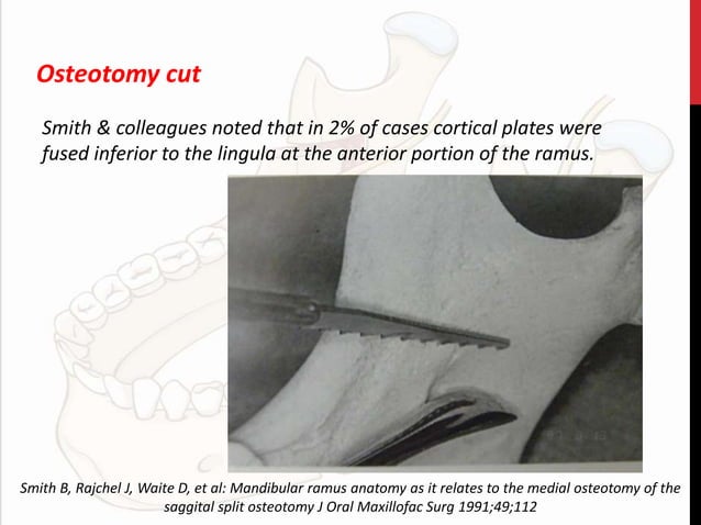 Mandibular osteotomies in orthognathic surgery of Face | PPTX