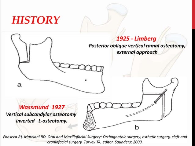 Mandibular osteotomies in orthognathic surgery of Face | PPTX