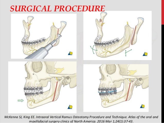 Mandibular osteotomies in orthognathic surgery of Face