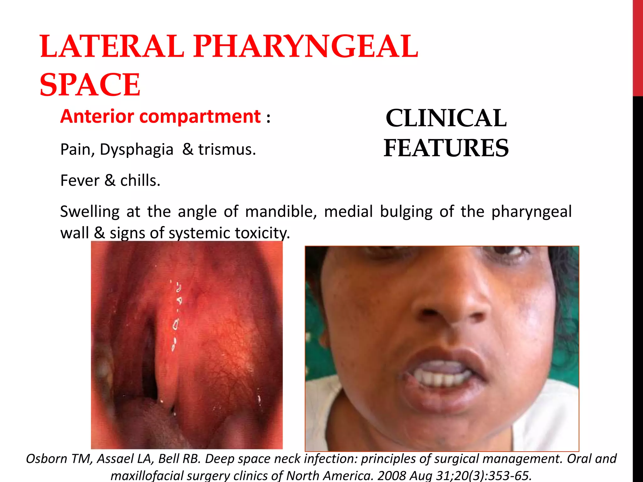 Deep space infections of Head and Neck | PPTX
