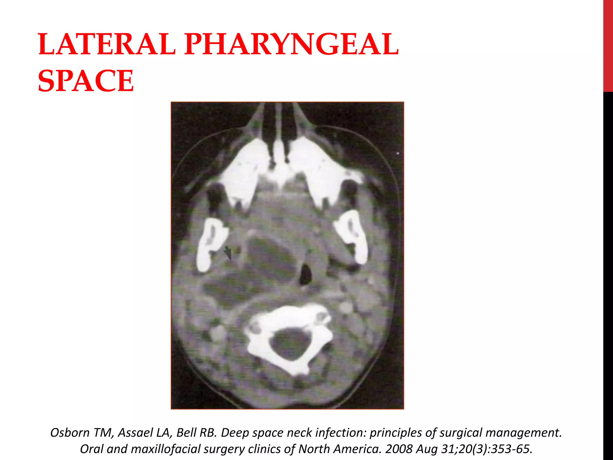 Deep space infections of Head and Neck | PPTX