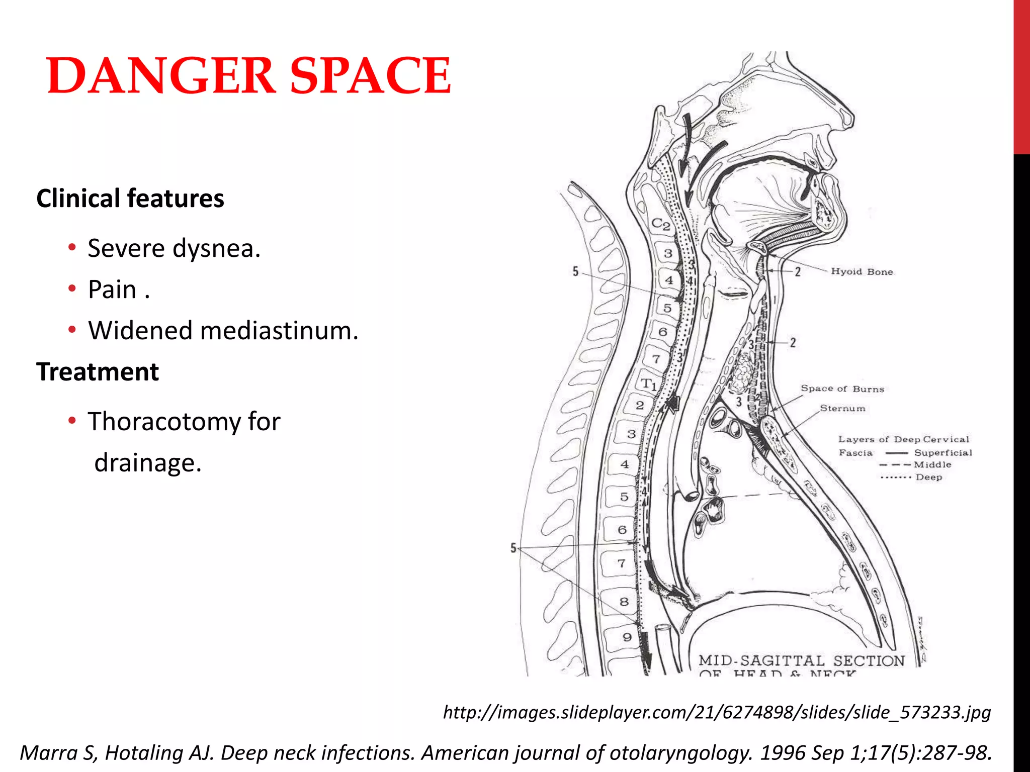Deep space infections of Head and Neck | PPTX