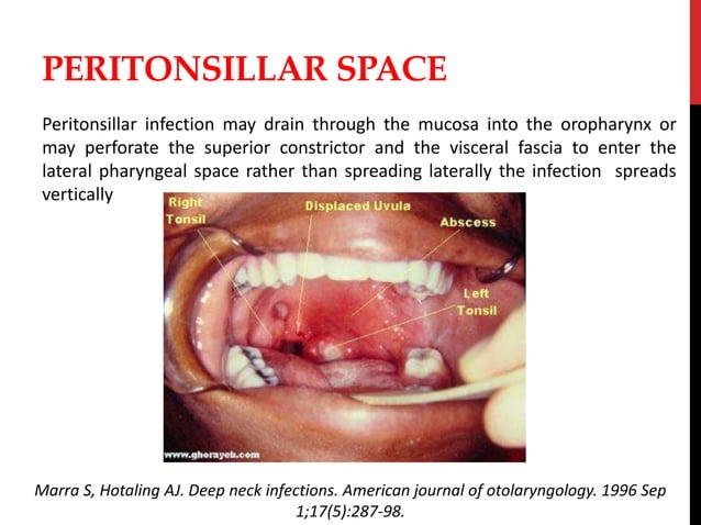 Deep space infections of Head and Neck | PPTX