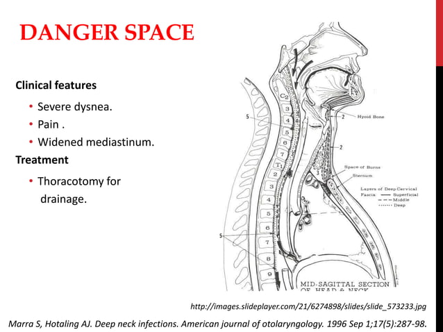Deep space infections of Head and Neck | PPTX