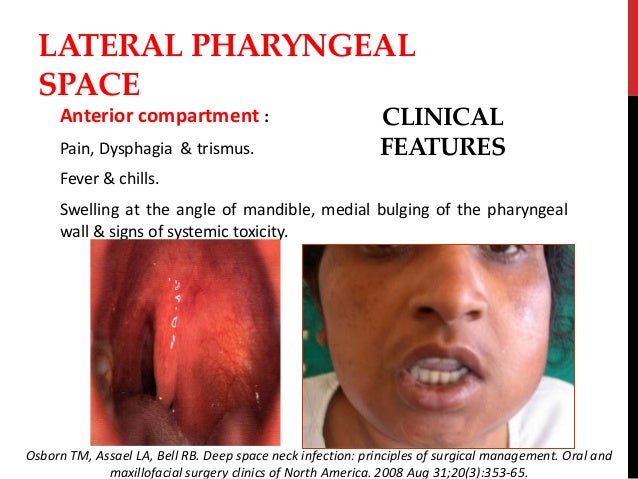 Deep space infections of Head and Neck