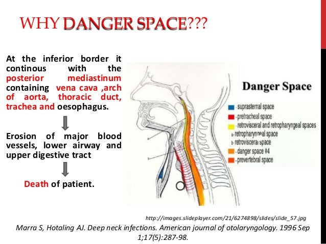 Deep space infections of Head and Neck