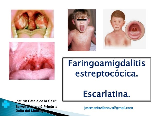 FARINGOAMIGDALITIS ESTREPTOCOCICA