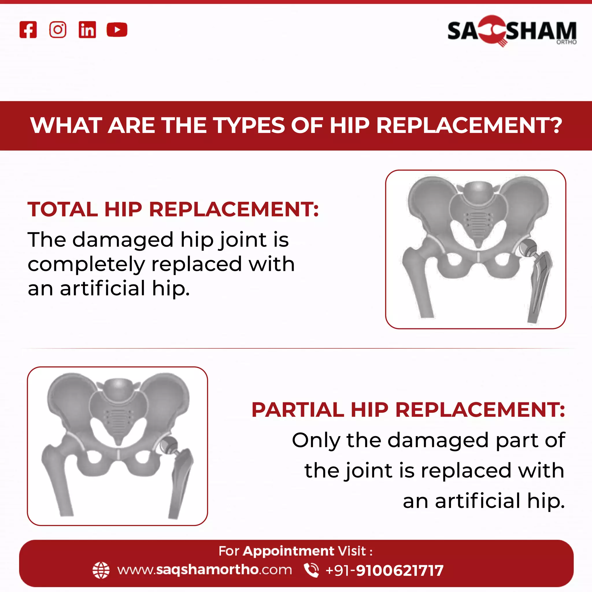 The Ultimate Guide to Hip Replacement Surgery | PDF