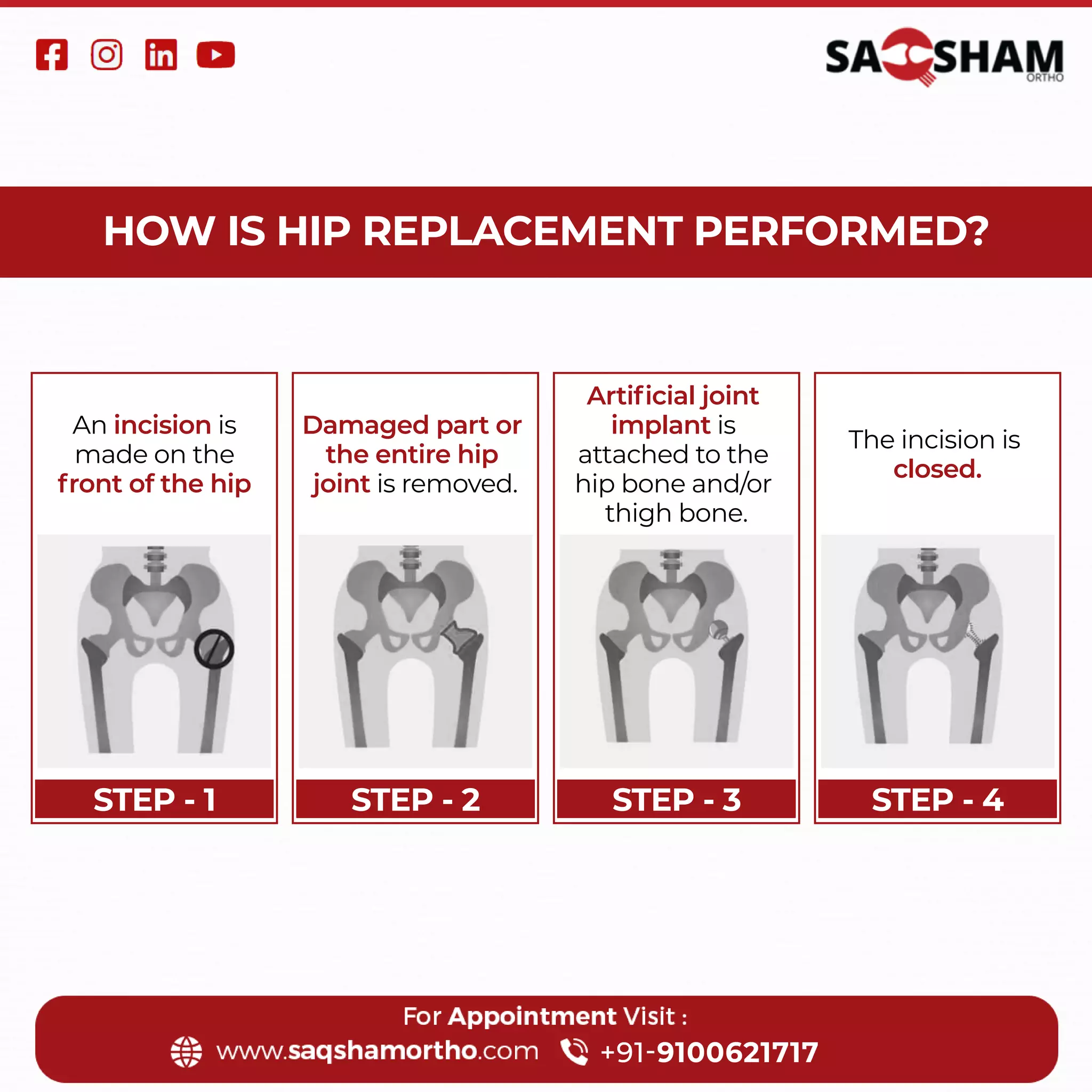 The Ultimate Guide to Hip Replacement Surgery | PDF