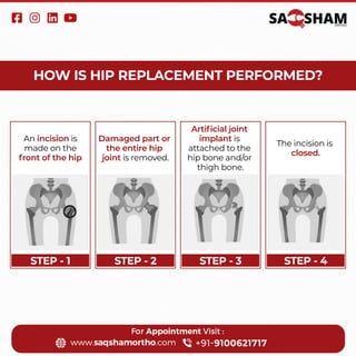 The Ultimate Guide to Hip Replacement Surgery | PDF | Physical Therapy ...