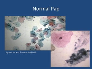 Cervical Cancer Screening | PPT
