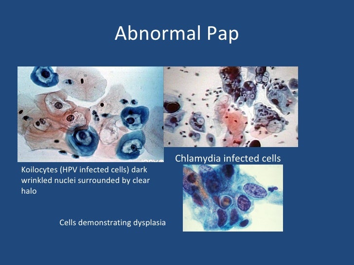 Cervical Cancer Screening