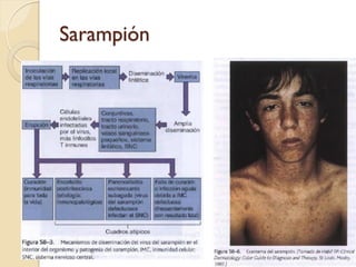 Sarampión, parotiditis, rubéola, hepatitis y vih | PDF